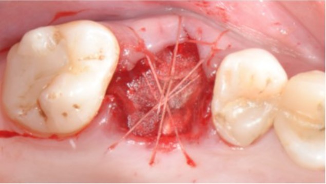 GUIDOR easy-graft - Simple procedures - RAVIV MEDICAL