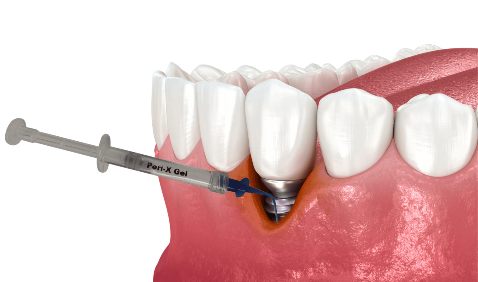 Peri-x Gel - RAVIV MEDICAL